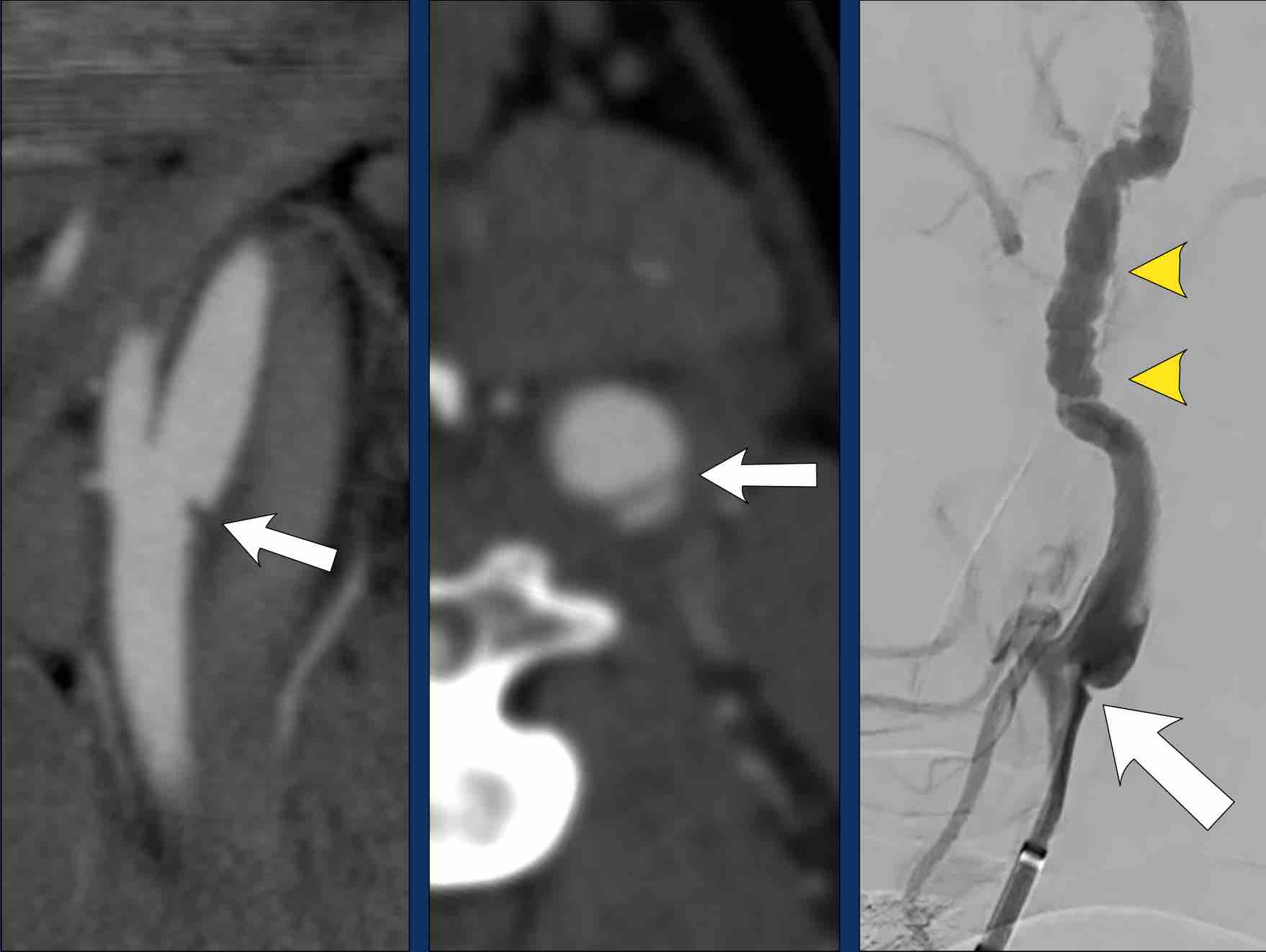 The Radiology Assistant : How to Differentiate Carotid Obstructions