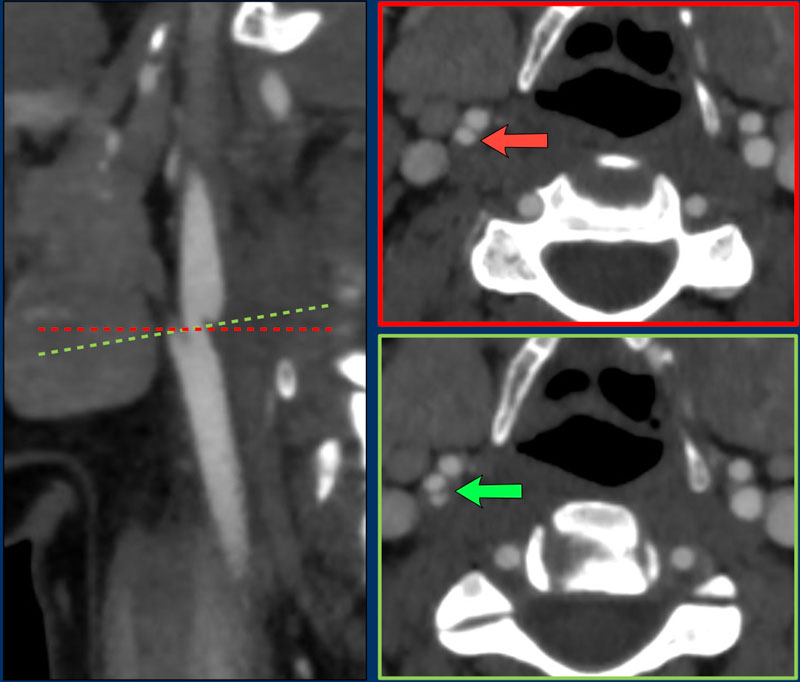 The Radiology Assistant : How to Differentiate Carotid Obstructions
