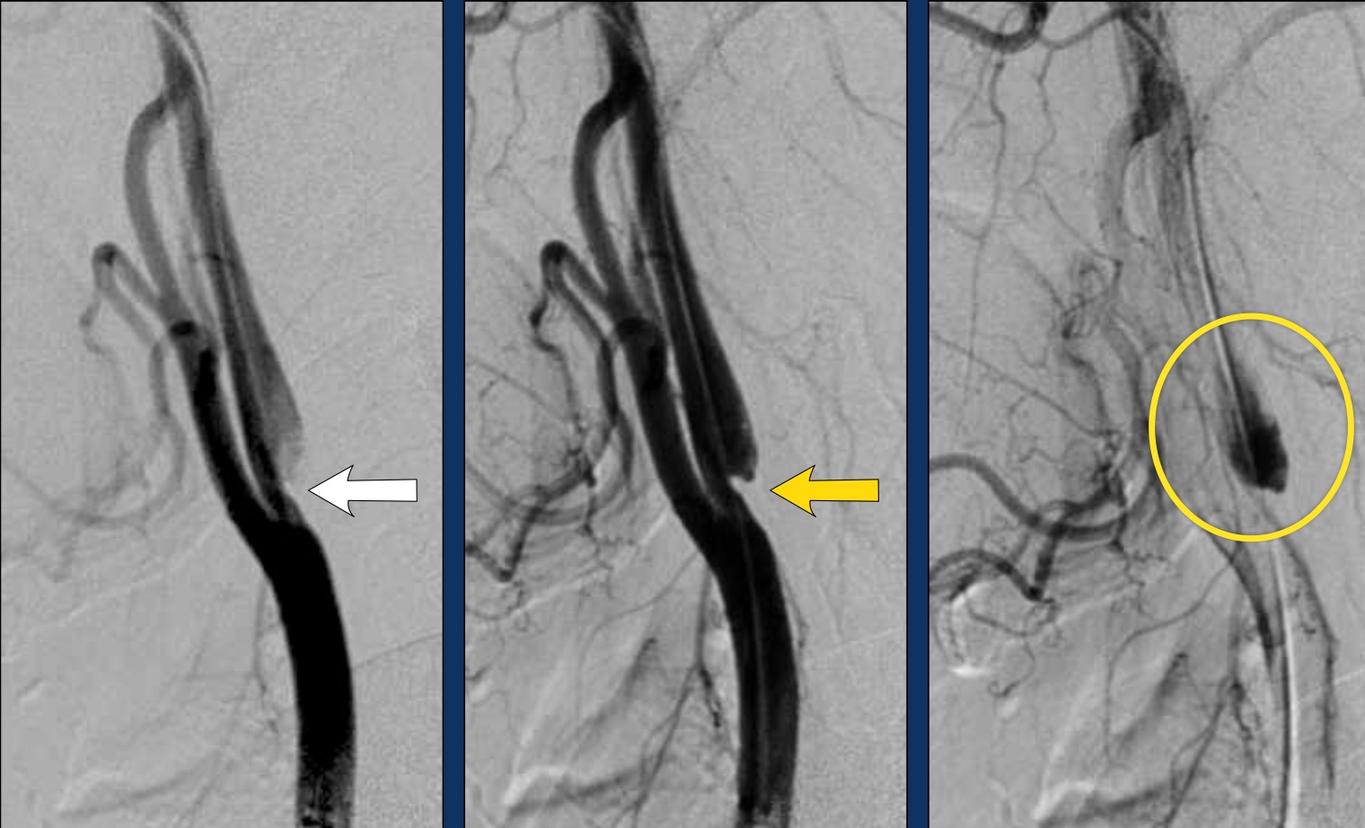 The Radiology Assistant : How to Differentiate Carotid Obstructions