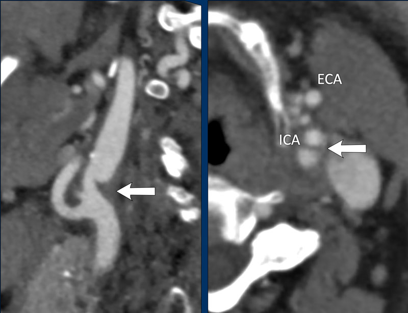 The Radiology Assistant : How to Differentiate Carotid Obstructions