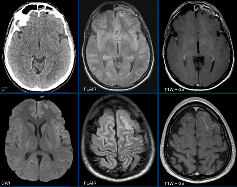 The Radiology Assistant : Enhancement Patterns in CNS disease