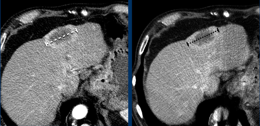 The Radiology Assistant : RECIST 1.1 - and more