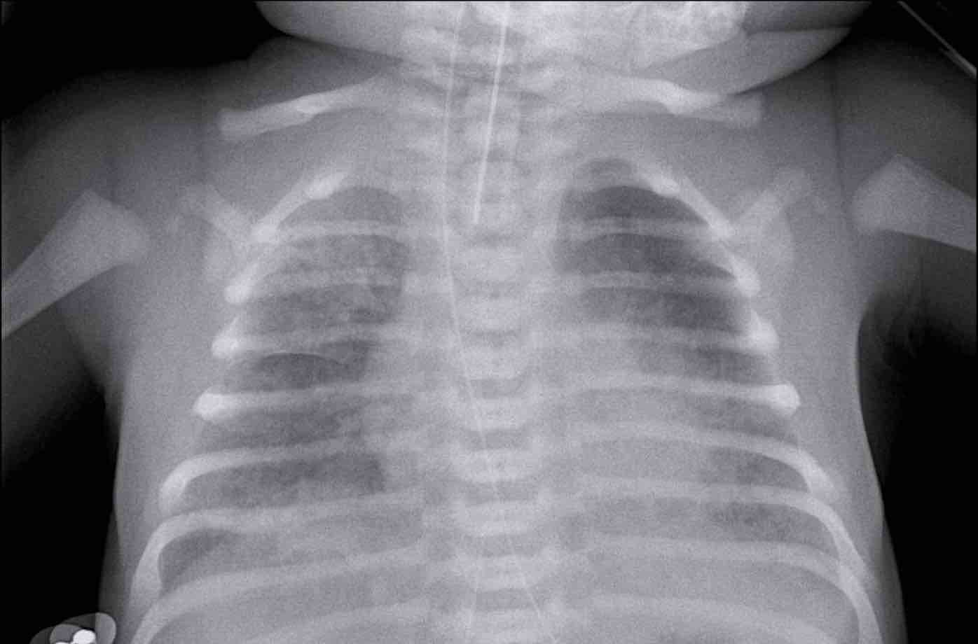 The Radiology Assistant : Neonatal Chest X-Ray