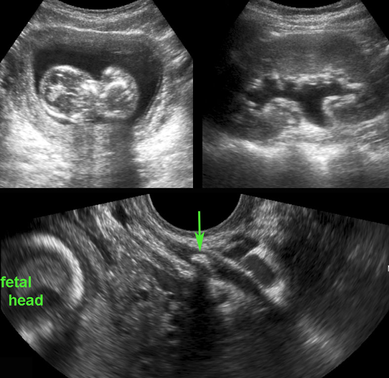 The Radiology Assistant : Transvaginal Ultrasound for Non ...