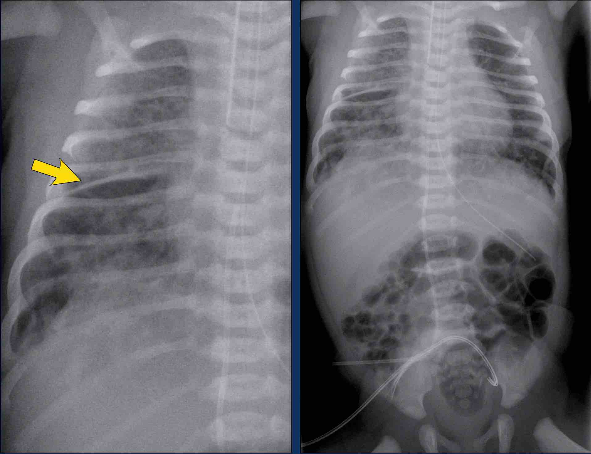 The Radiology Assistant : Neonatal Chest X-Ray