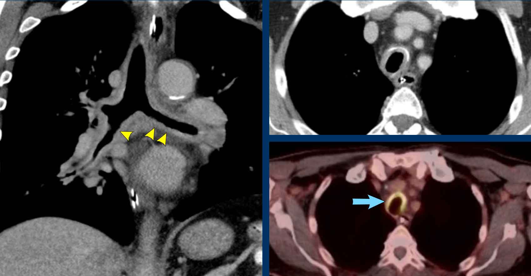 The Radiology Assistant : Large airway disease