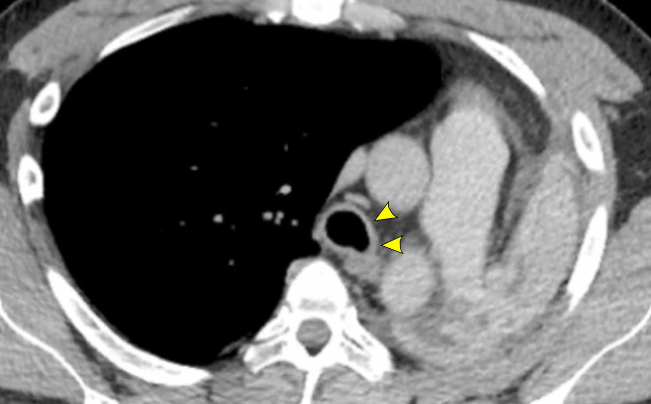 The Radiology Assistant : Large airway disease