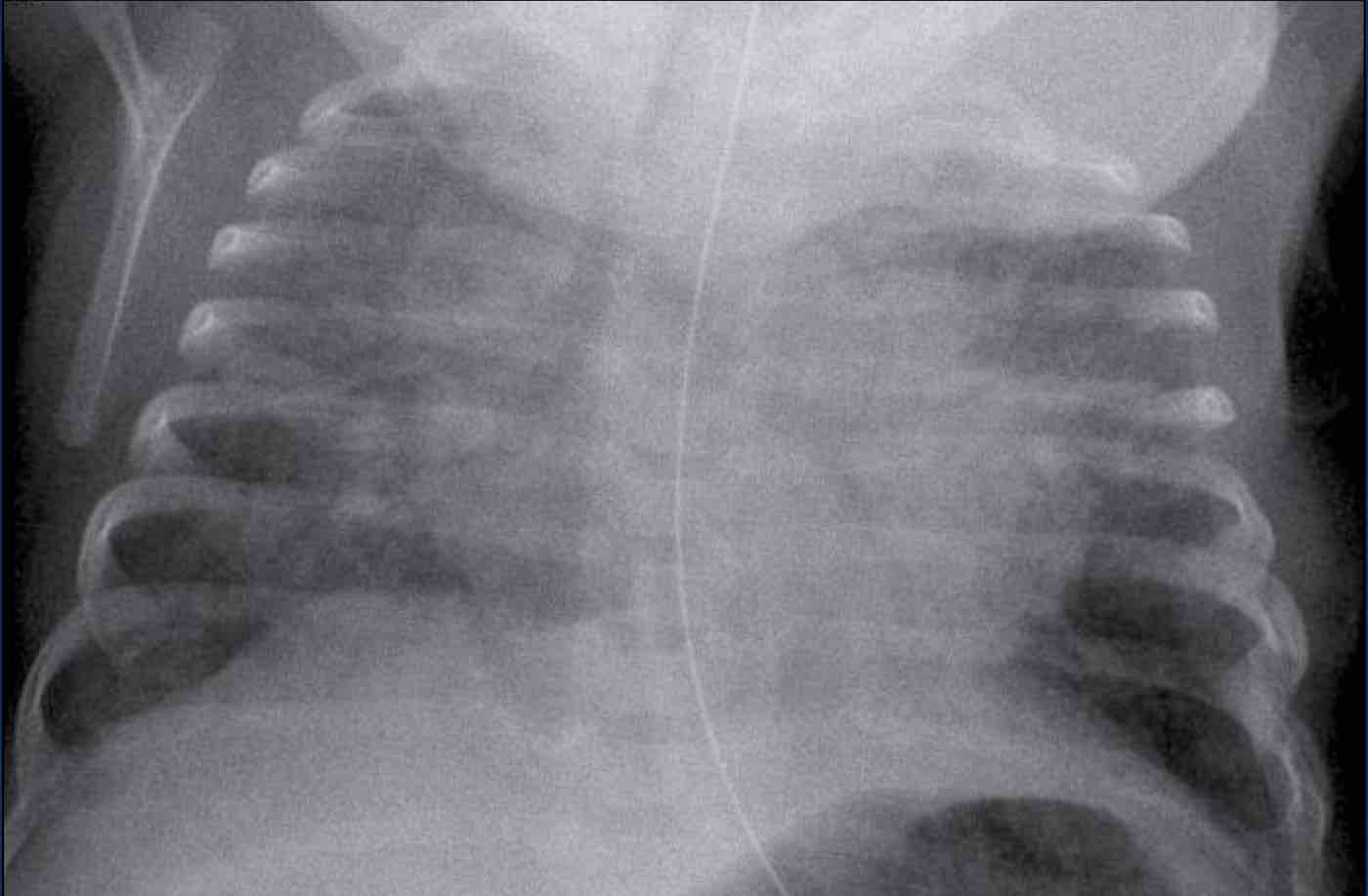 The Radiology Assistant : Neonatal Chest X-Ray