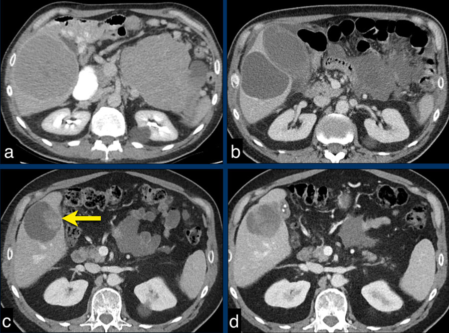 The Radiology Assistant : RECIST 1.1 - and more