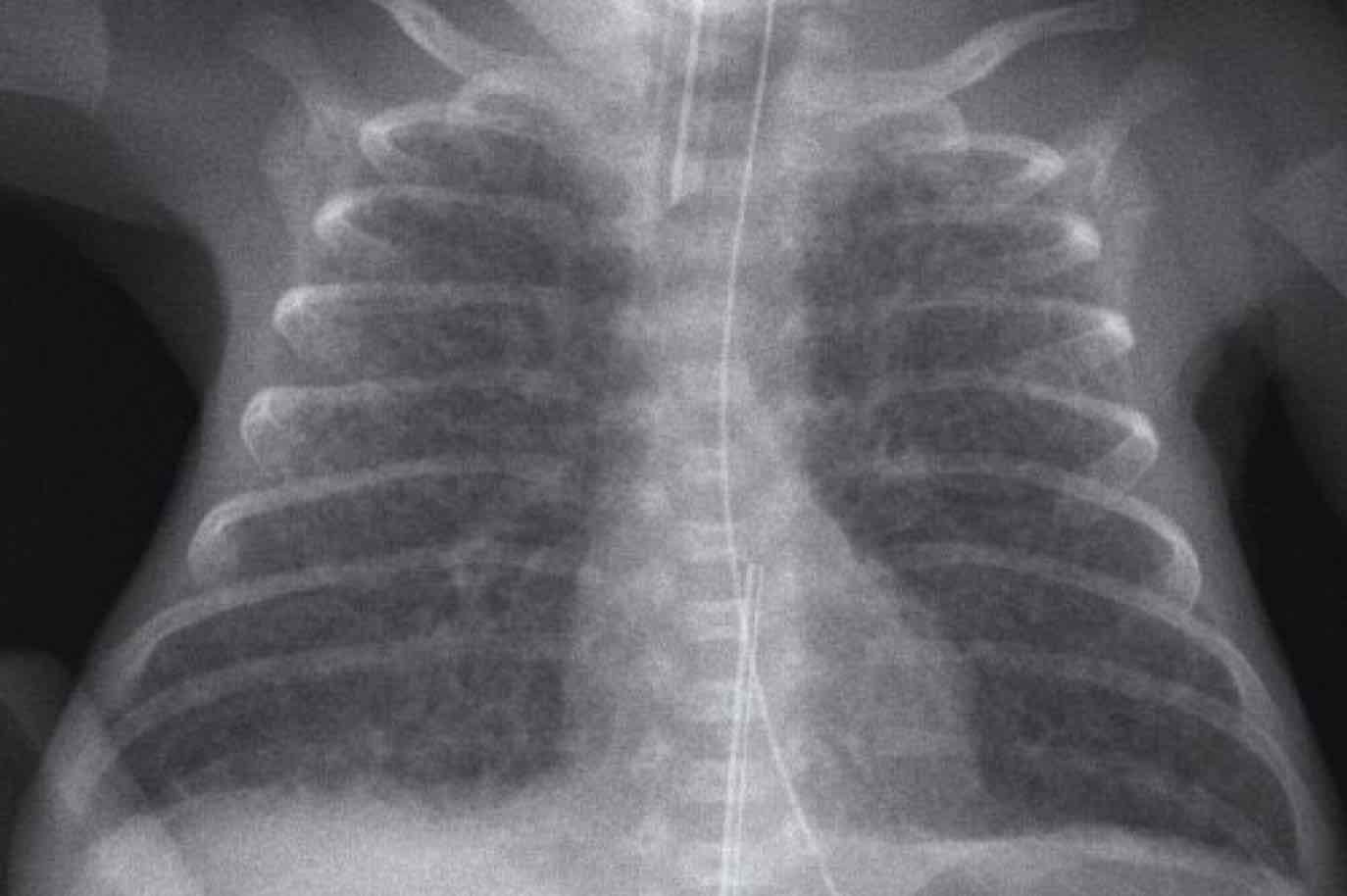 The Radiology Assistant : Neonatal Chest X-Ray