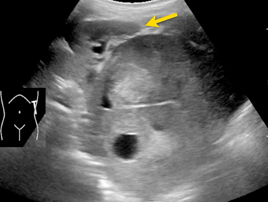 The Radiology Assistant : Solid Abdominal Masses in Children