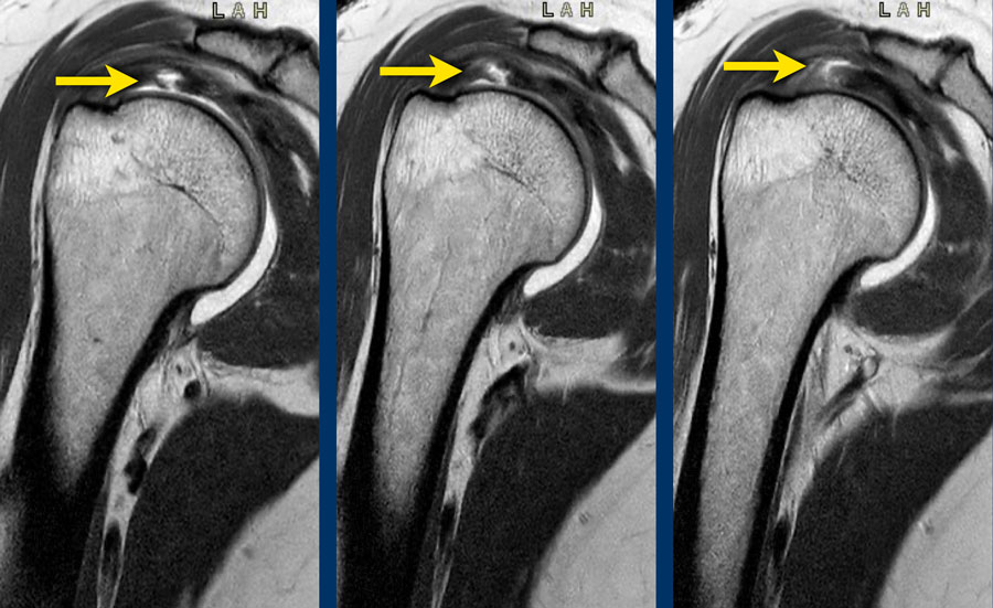 The Radiology Assistant : Shoulder - Rotator cuff injury
