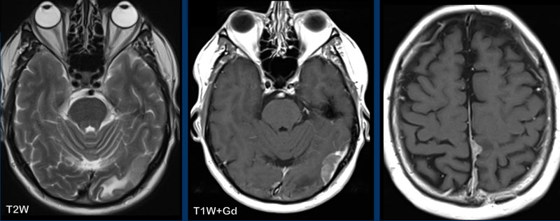 The Radiology Assistant : Enhancement Patterns in CNS disease