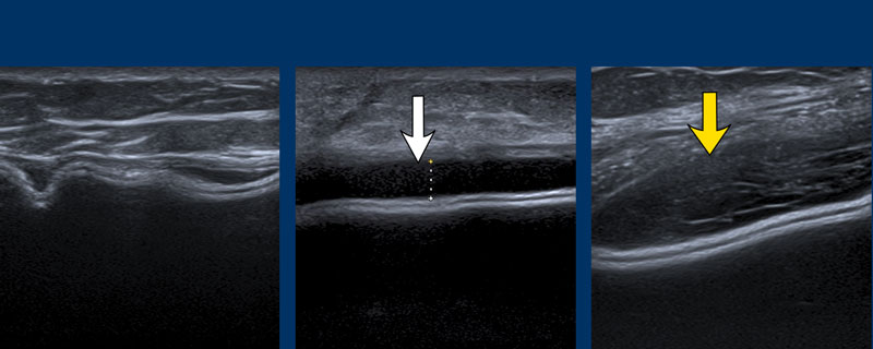The Radiology Assistant : Breast Implants