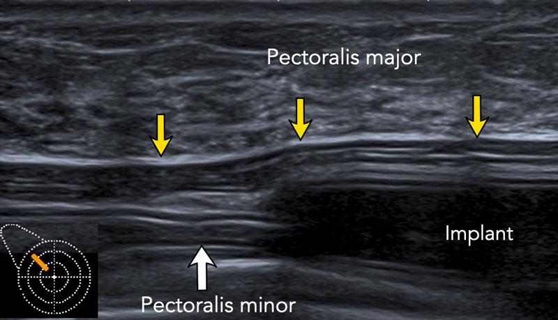 The Radiology Assistant : Breast Implants