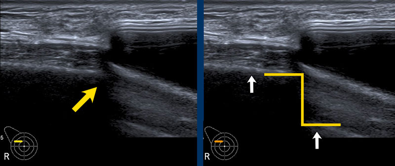 The Radiology Assistant : Breast Implants