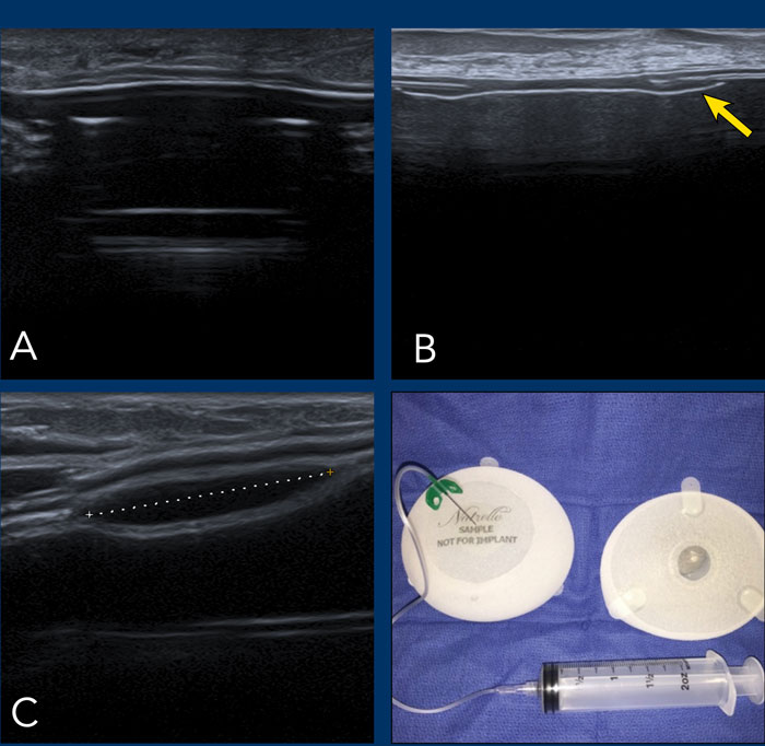 The Radiology Assistant : Breast Implants