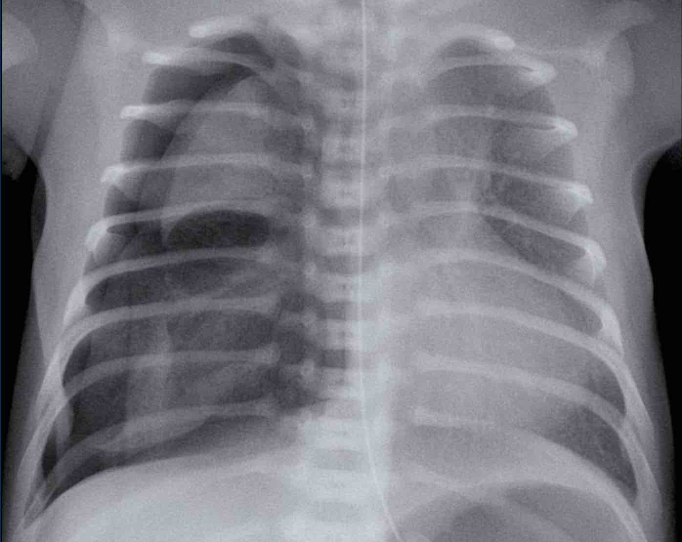 The Radiology Assistant : Neonatal Chest X-Ray