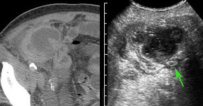 The Radiology Assistant : Appendicitis - US findings