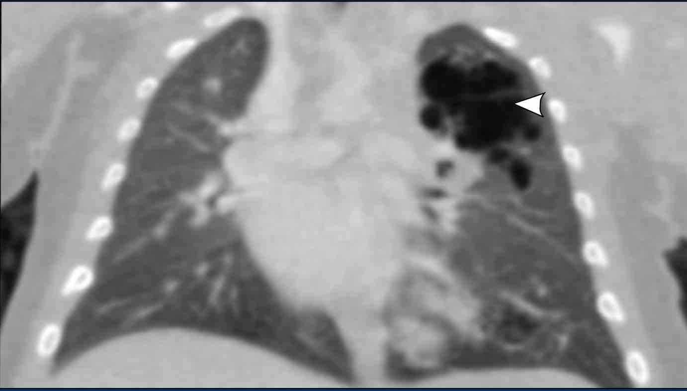 The Radiology Assistant : Neonatal Chest