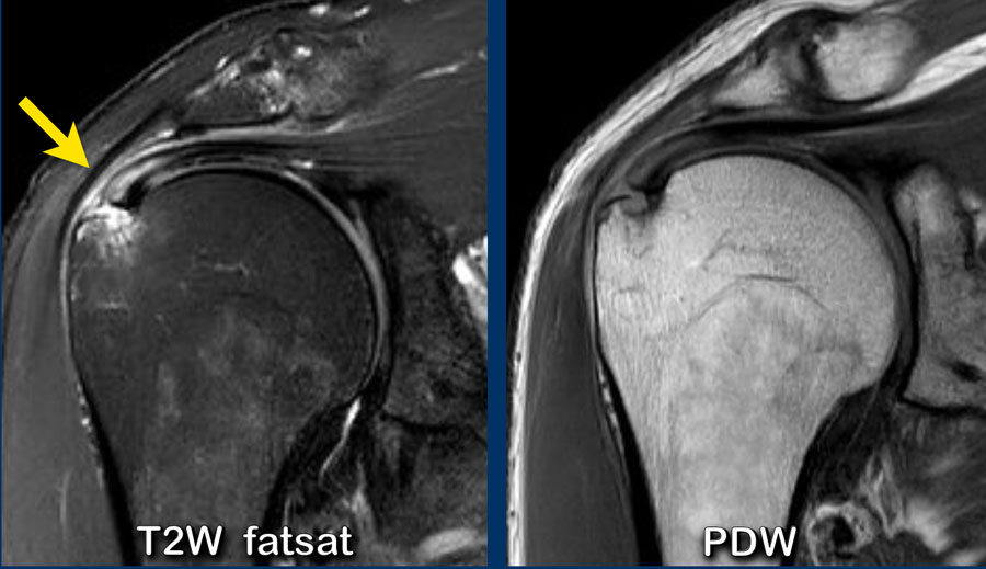 The Radiology Assistant : Shoulder Rotator cuff injury