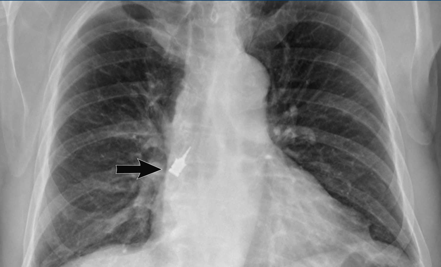 The Radiology Assistant : Large airway disease