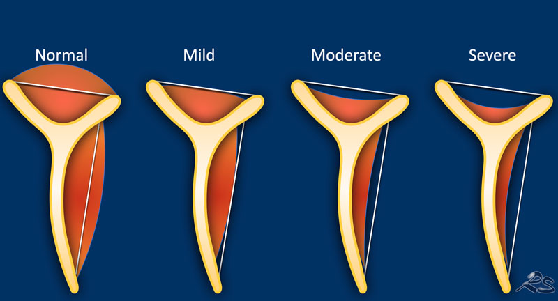 The Radiology Assistant : Shoulder - Rotator cuff injury