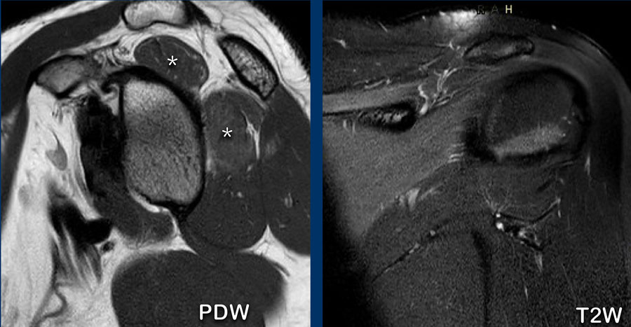 The Radiology Assistant : Shoulder - Rotator cuff injury