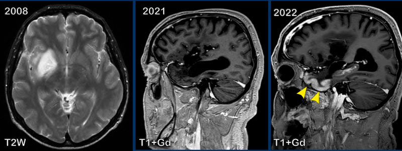 The Radiology Assistant : Enhancement Patterns in CNS disease