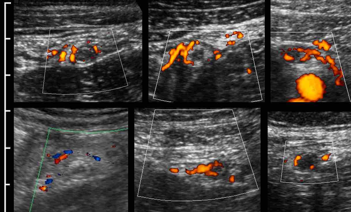 How To Diagnose Acute Appendicitis Ultrasound First
