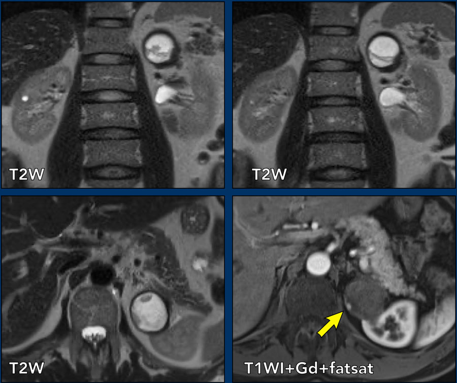The Radiology Assistant : Bosniak Classification 2019