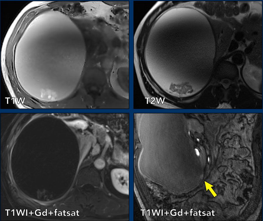 The Radiology Assistant : Bosniak Classification 2019