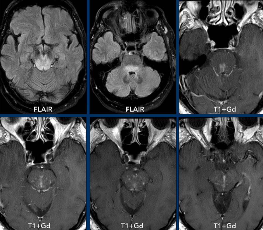 The Radiology Assistant : Enhancement Patterns in CNS disease