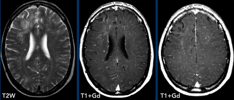 The Radiology Assistant : Enhancement Patterns in CNS disease