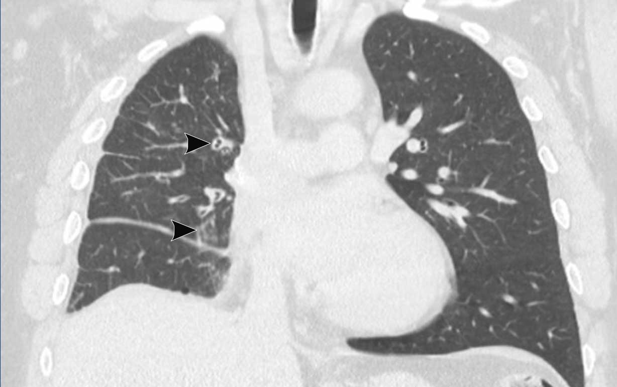 The Radiology Assistant : Large airway disease