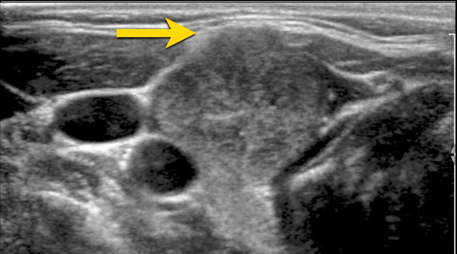 The Radiology Assistant : TI-RADS - Thyroid Imaging Reporting and Data ...