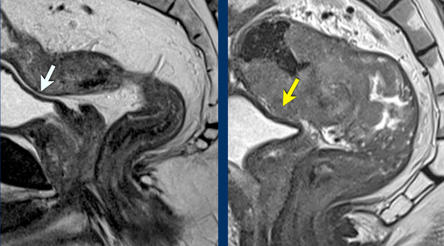 The Radiology Assistant : Rectal Cancer MR staging 3.0