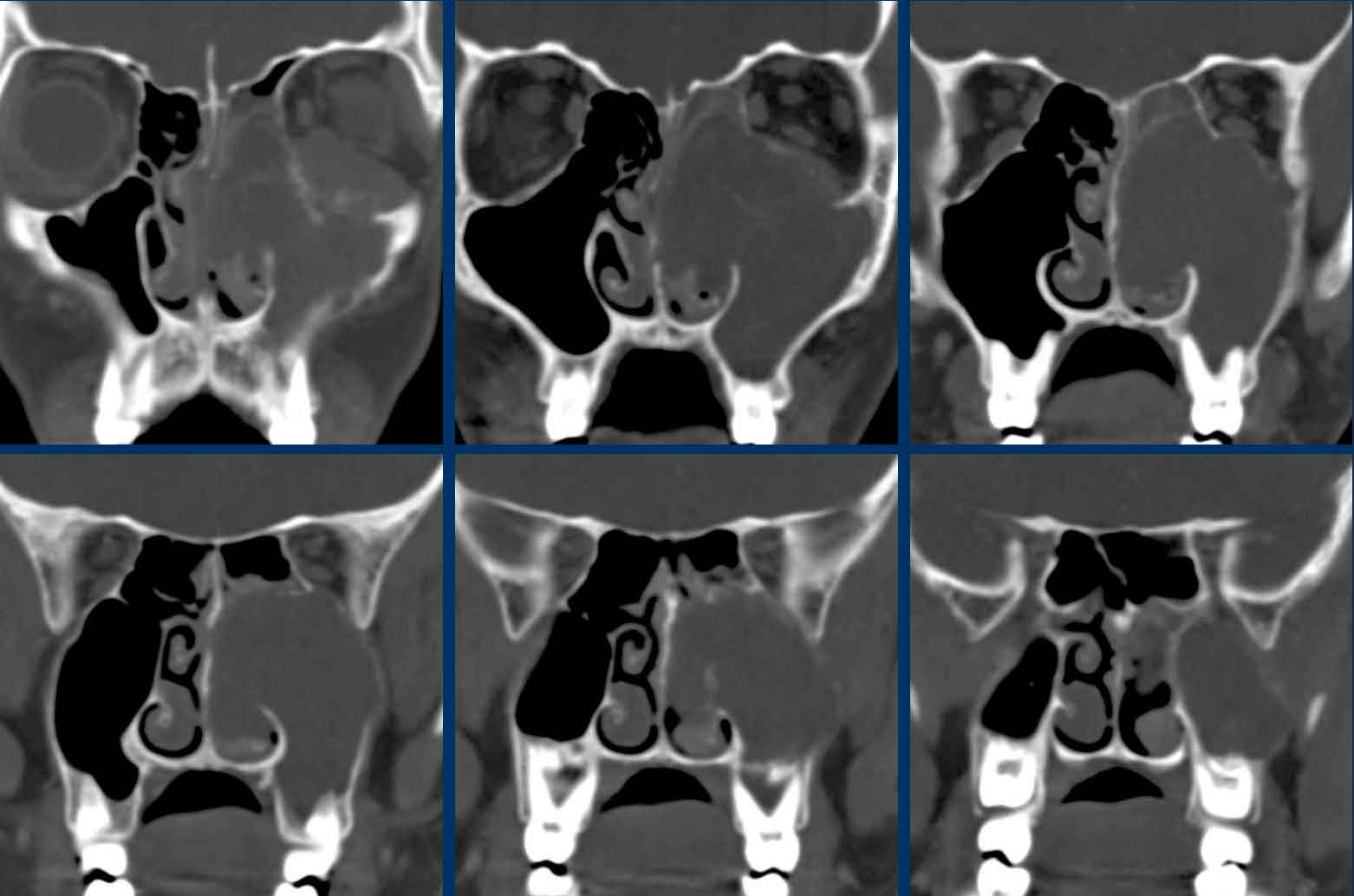 The Radiology Assistant : Head Neck tumors - When to think of malignancy