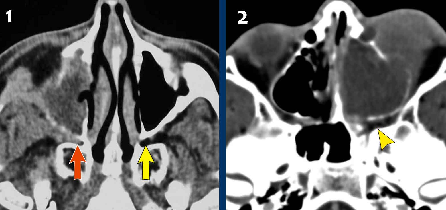 The Radiology Assistant : Head Neck tumors - When to think of malignancy