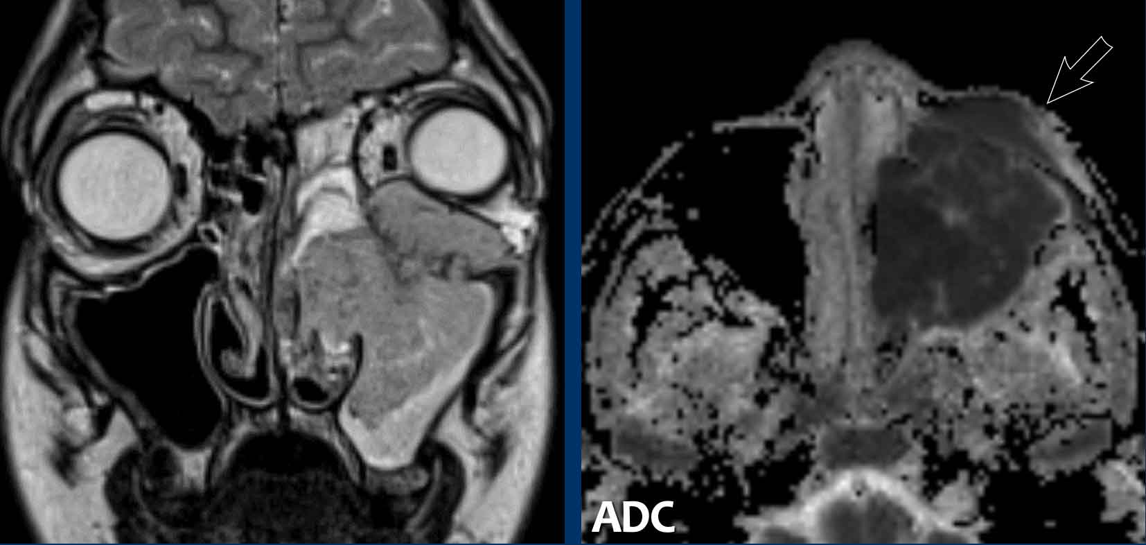 The Radiology Assistant : Head Neck tumors - When to think of malignancy