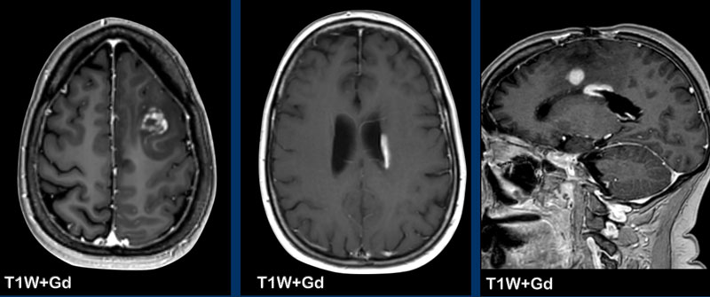 The Radiology Assistant : Enhancement Patterns in CNS disease