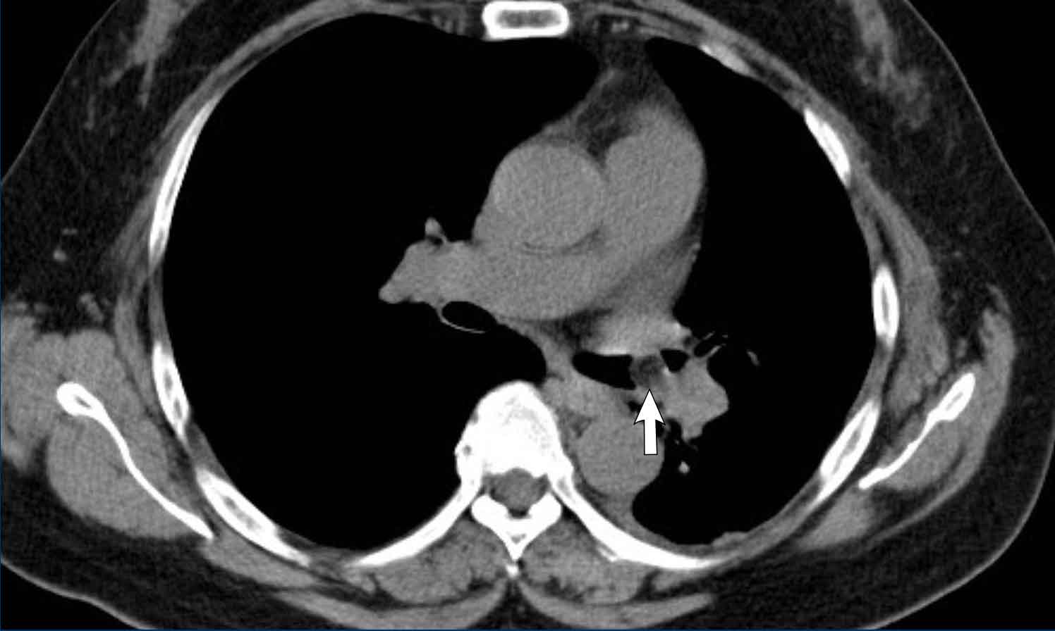 The Radiology Assistant : Large airway disease