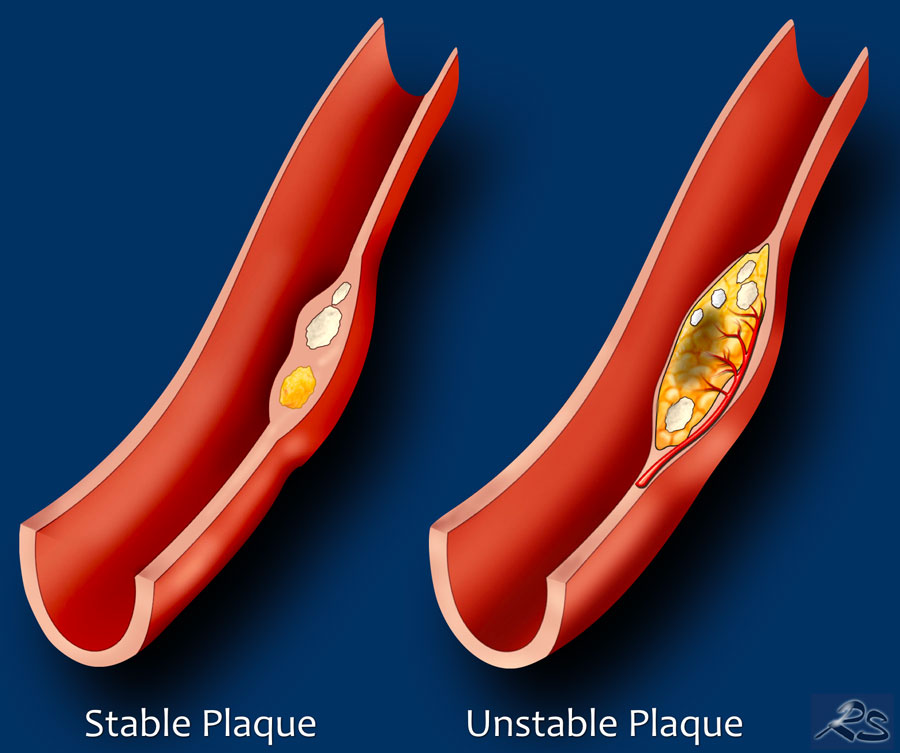 The Radiology Assistant : CAD-RADS