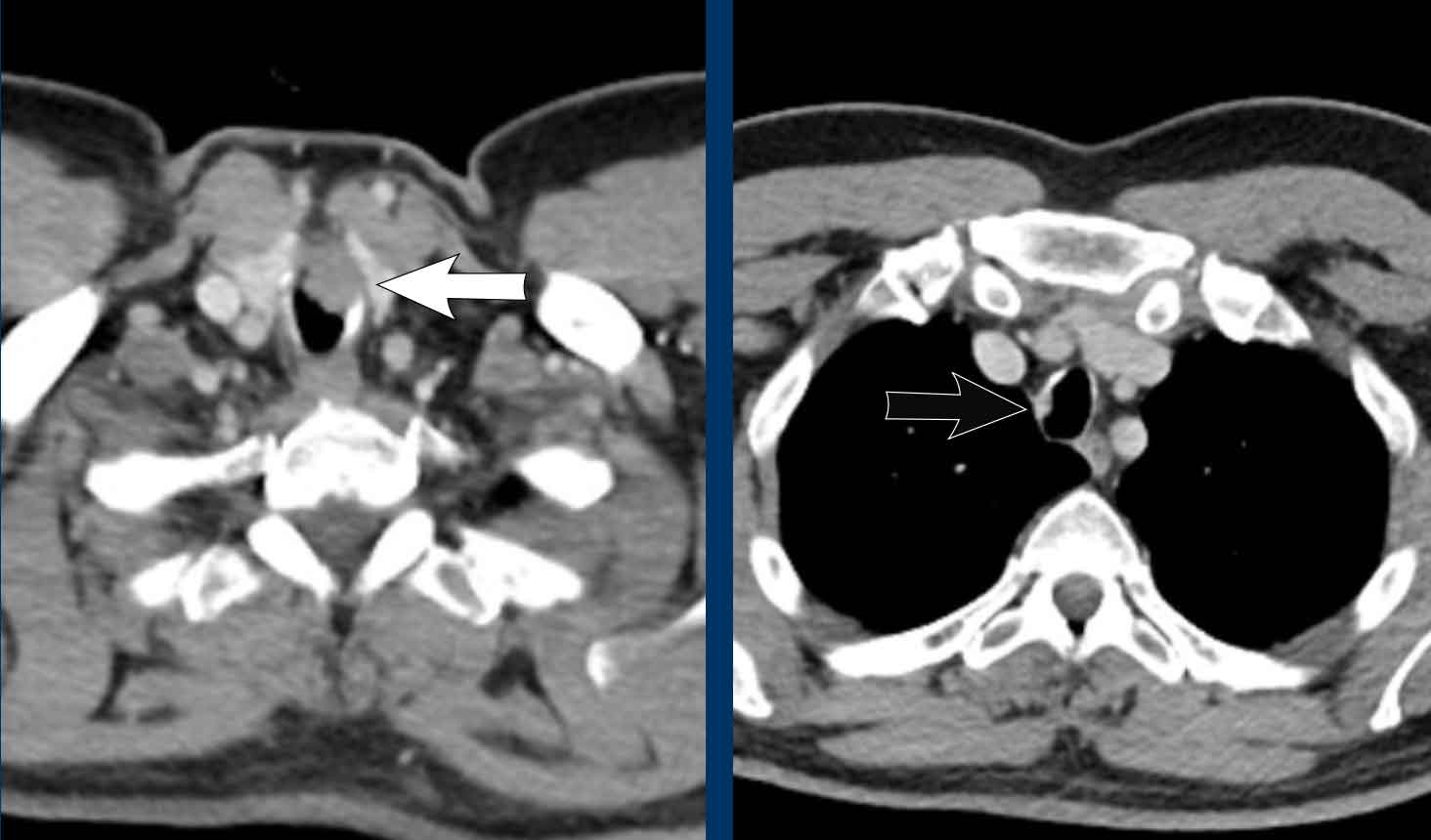 The Radiology Assistant : Large airway disease