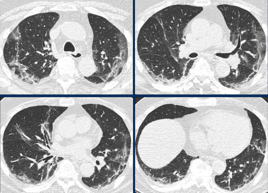 The Radiology Assistant : 32 cases of suspected COVID-19