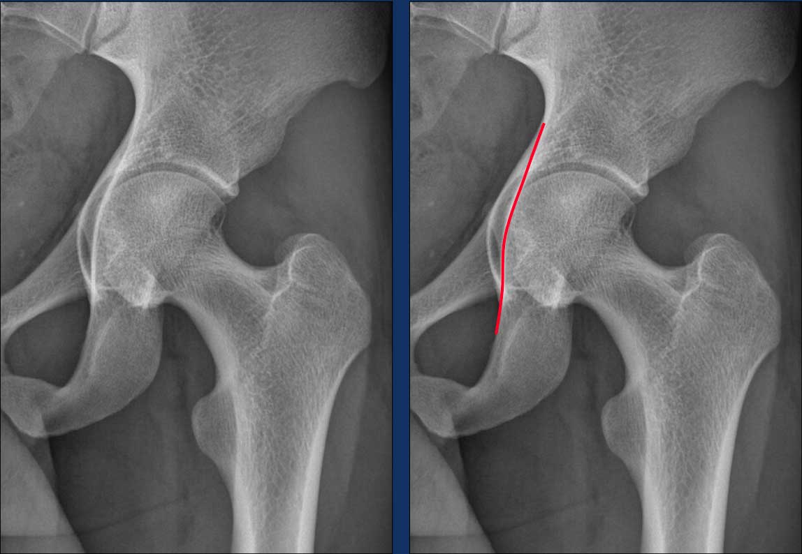 The Radiology Assistant : Femoroacetabular impingement syndrome