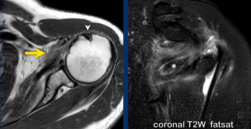The Radiology Assistant : Shoulder - Rotator cuff injury