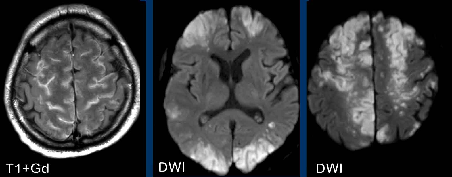 The Radiology Assistant : Enhancement Patterns in CNS disease