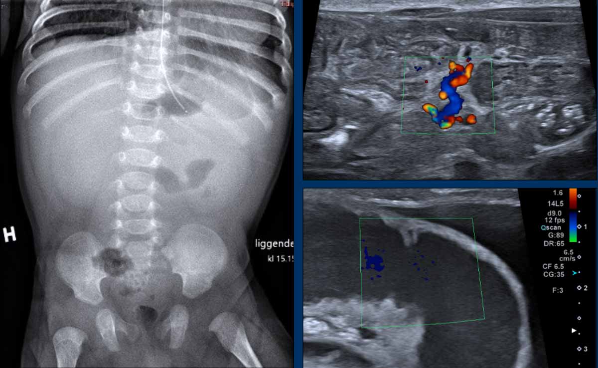 The Radiology Assistant : Necrotizing Enterocolitis