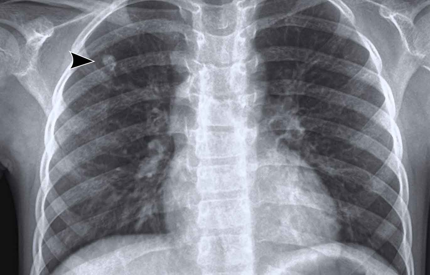 Tuberculosis X Ray Primary Mycobacterium Tuberculosis Chest